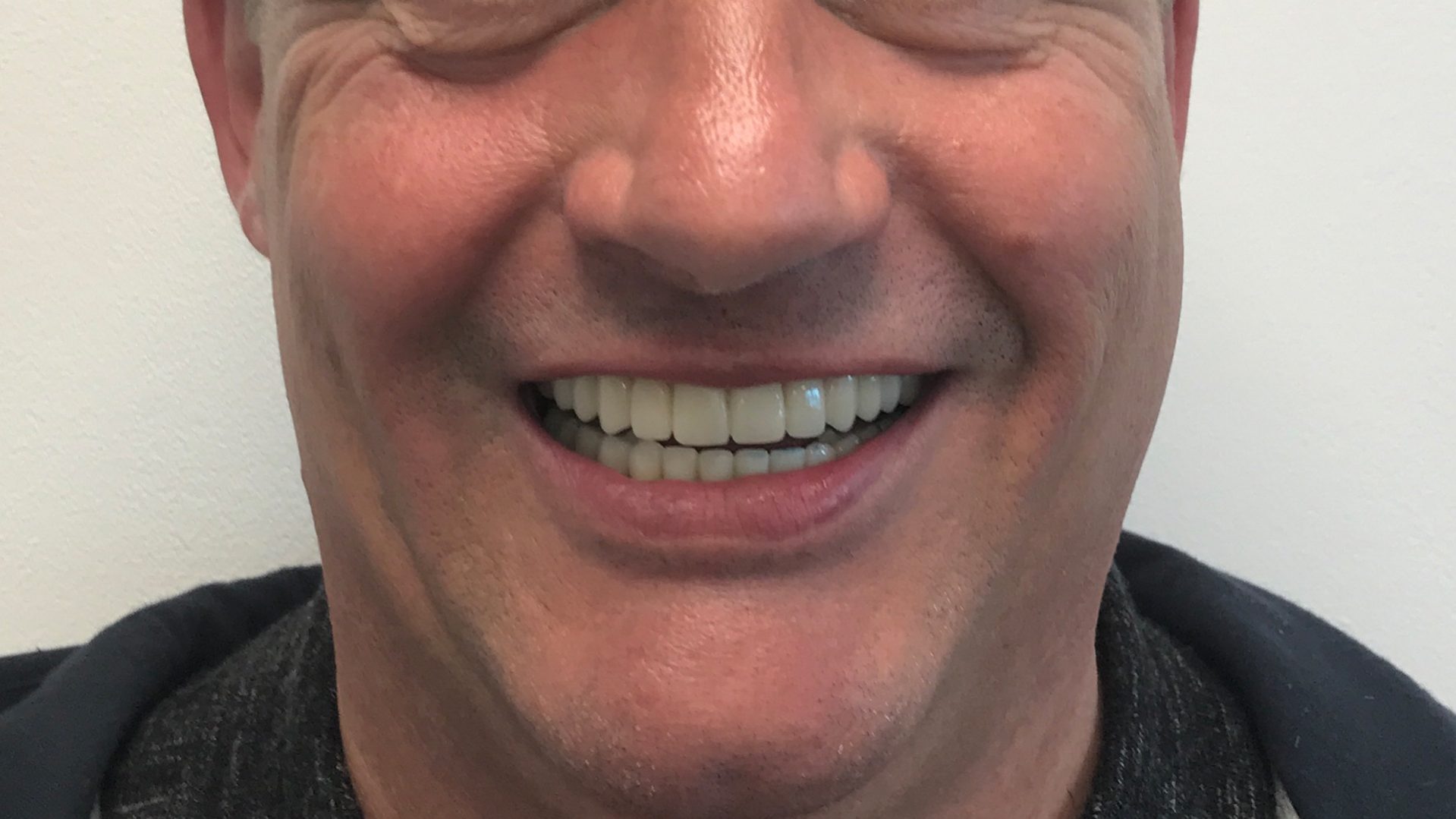The Benefits Of Dental Implants | A Brand New Smile In 1 Day