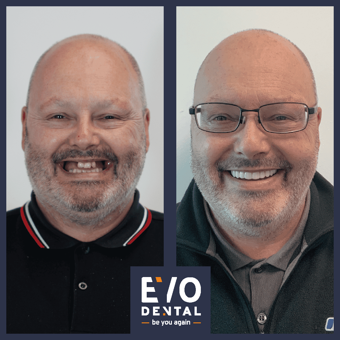 Dental Implants Leeds | Book A Free Consultation In Leeds
