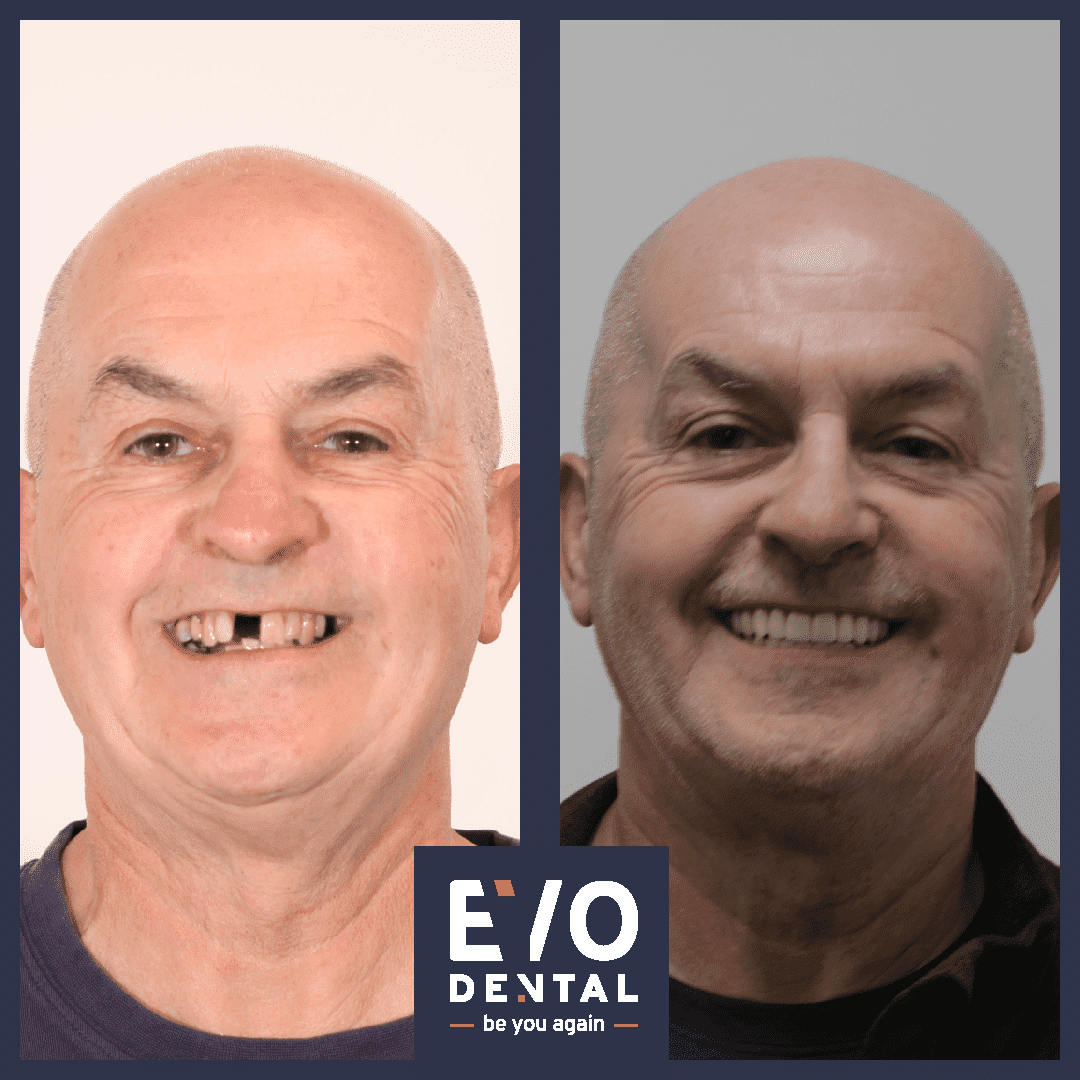 Full Mouth Dental Implants Wolverhampton - EvoDental