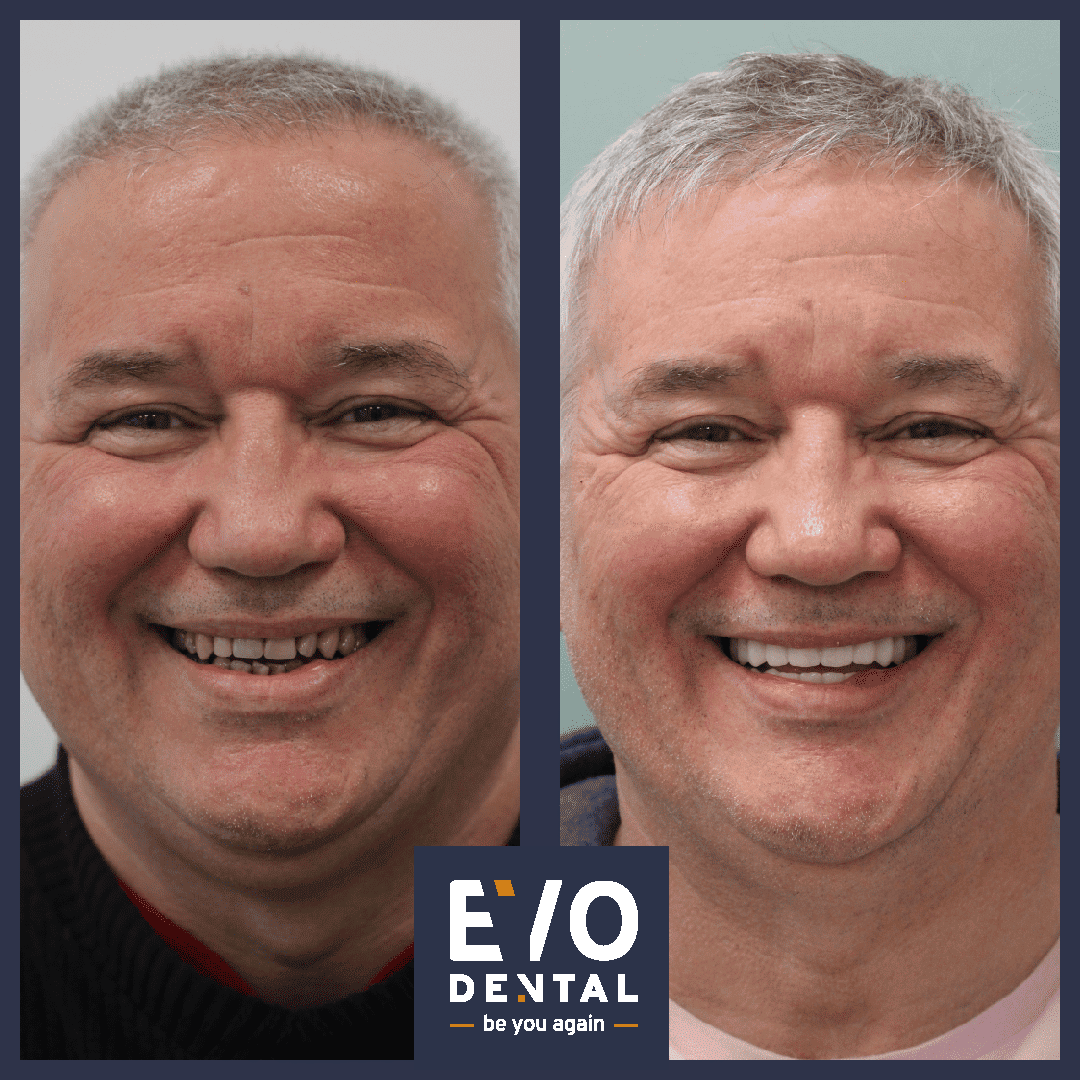 Full Mouth Dental Implants Wolverhampton - EvoDental