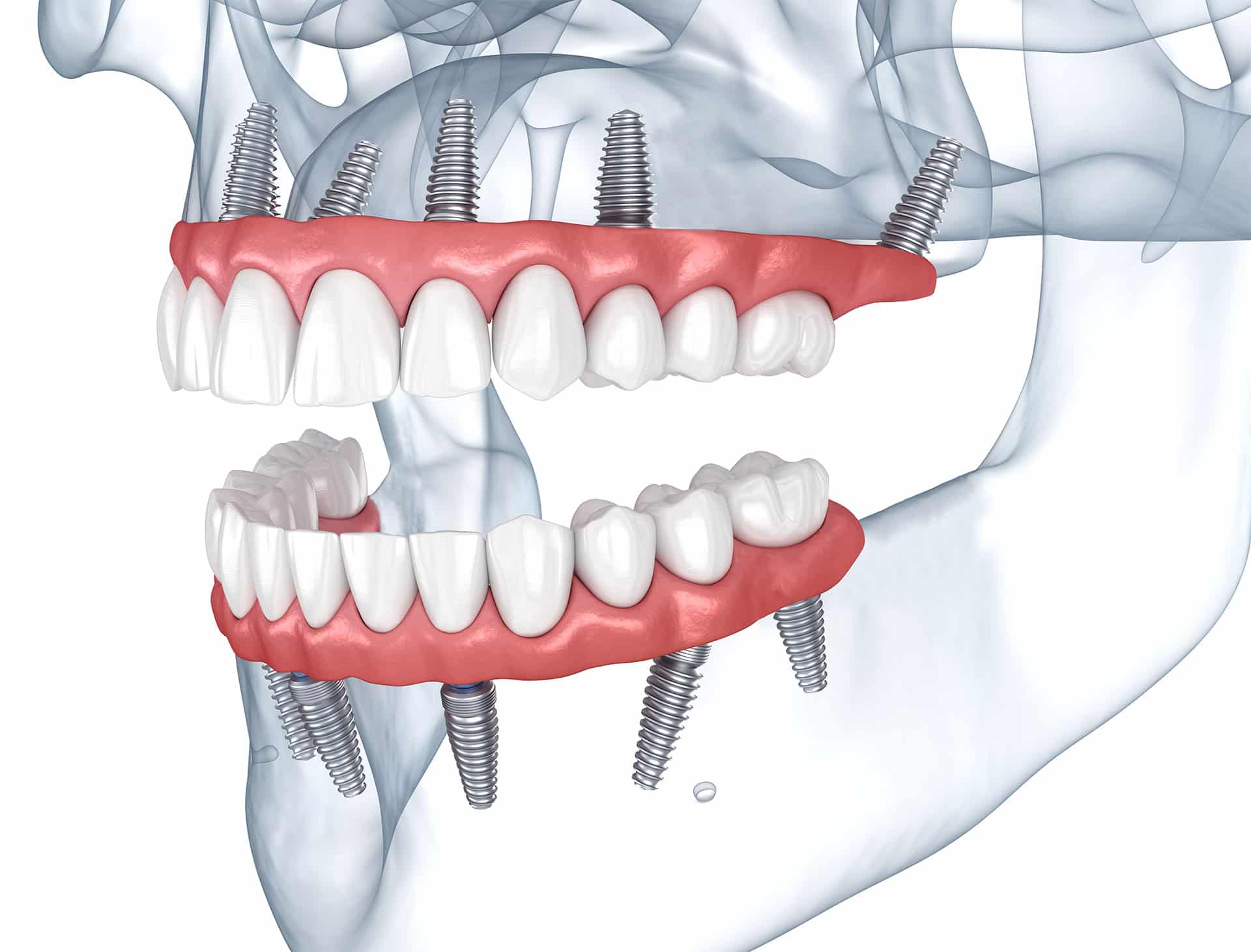 The UK's Leading Full Mouth Dental Implant Experts | EvoDental